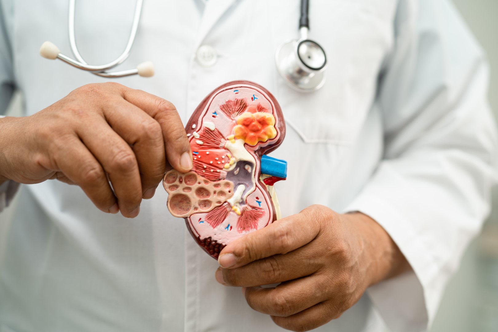 Böbrek Taşı Nasıl Olur? - Probiyotix